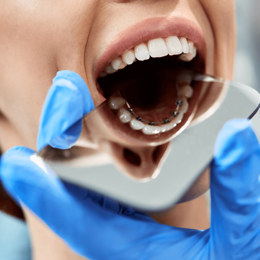 Lingual Retainer | Godent